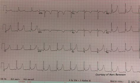 Osborn Waves Ecg Guru Instructor Resources
