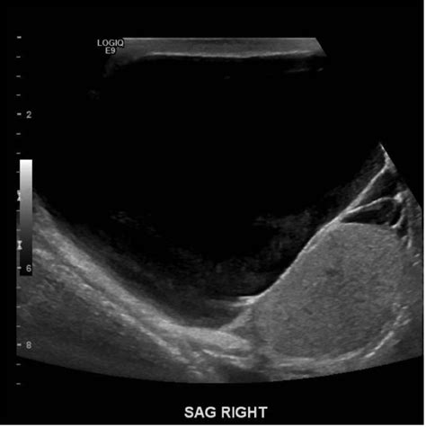 Epididymal Cyst Ultrasound