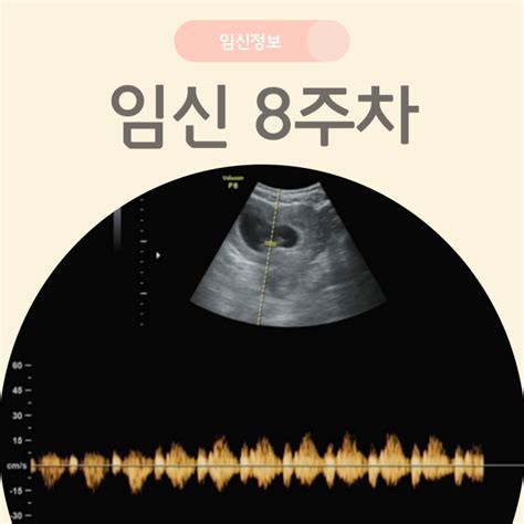 임신 8주차 증상 아기 심장소리 듣는 시기 네이버 블로그