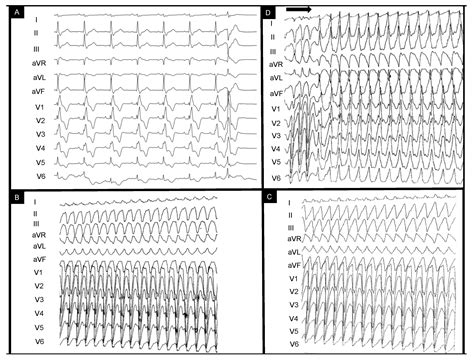 Complex Substrate Leading To Pvc Mediated Systolic Dysfunction In