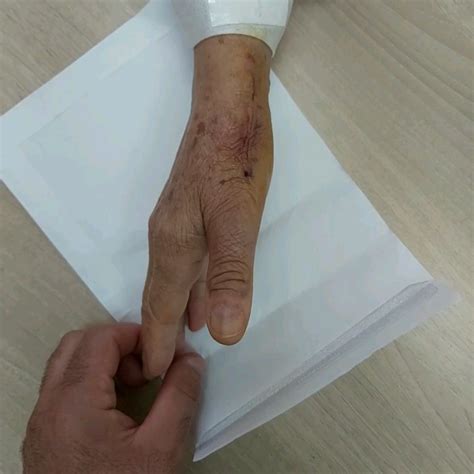 Mustafa Naamnih M D On Linkedin A 70 Year Old Female 2 Weeks After