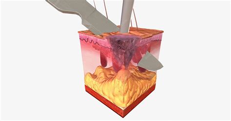 Premium Photo The Excisional Biopsy Close Up