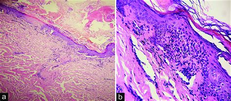 A Skin Biopsy Shows Hyperkeratosis Mild Atrophy Perivascular And Download Scientific