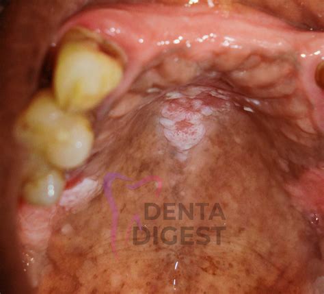 10 Things You Should Know About Leukoplakia In 2023 Dentadigest