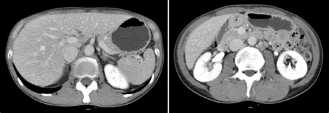 Abdominal Computed Tomography Reveals No Evidence Of Recurrence Of Gist