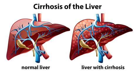 Liver Cirrhosis Symptoms Causes Prevention And Treatments