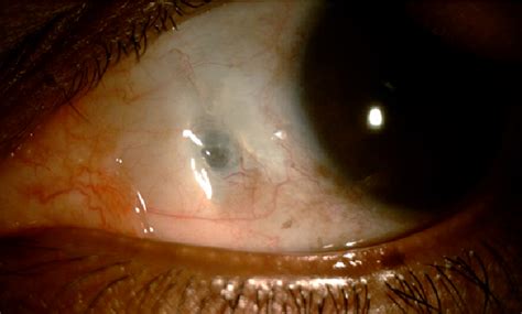 Figure 1 From Scleral Patch Graft With Fibrin Adhesive For Post