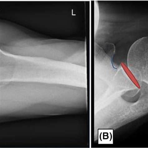 A It Demonstrates A Typical Superior Inferior Axial Shoulder Download Scientific Diagram