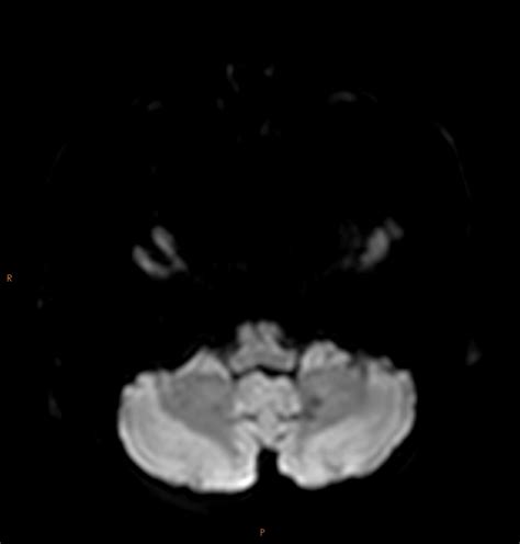 File Diffuse Astrocytoma IDH Mutant Radiopaedia 98918 120113 Axial 113 NC Commons