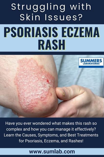How Can You Tell The Difference Between Seborrheic Dermatitis And