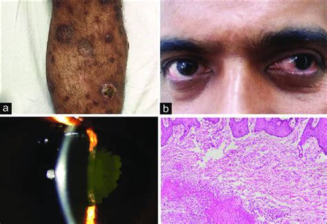 A Multiple Hyperpigmented To Skin Colored Papules And Nodules Present Download Scientific