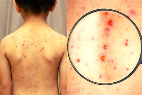 ৬ টি ঘরোয়া টোটকা । চিকেন পক্স হলে কি করব জানুন Progotir Bangla