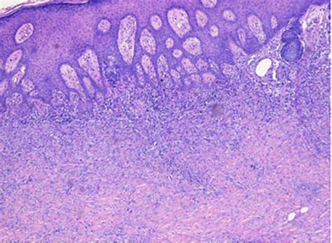 Figure 2 From Ulcerated Giant Dermatofibroma Following Routine