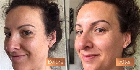 Collagen Peptides Results At Catrina Franzen Blog