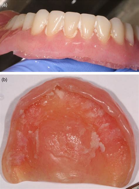 Denture Stomatitis—an Interdisciplinary Clinical Review Mcreynolds