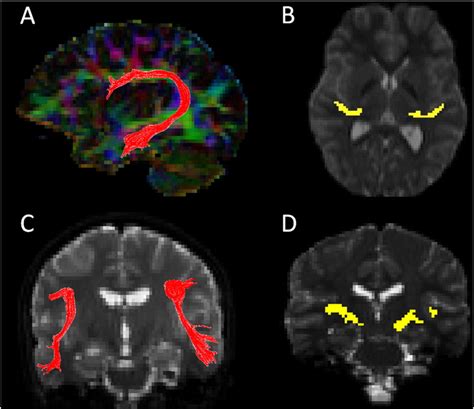 Fiber Tractography Of The Arcuate Fasciculus From A 16p112 Deletion