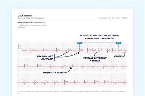 Sinus Rhythm Vs Ectopic Atrial Rhythm On Your Watch Ecg Qaly
