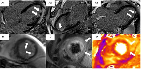 Frontiers The Role Of Cardiac Magnetic Resonance In Myocardial Infarction And Non Obstructive