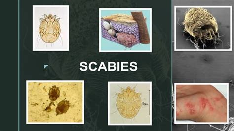 Scabies Pptx