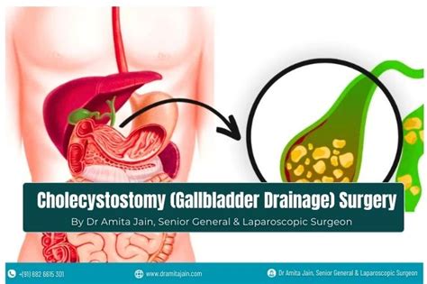 Best Cholecystostomy Gallbladder Drainage Surgeon In Delhi Dr Amita Jain