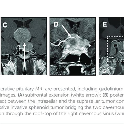 Logistic Regression Model Predicting Surgical Complications Download