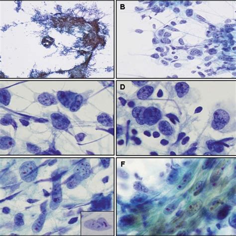 Fig C 1 Fine Needle Aspiration Cytology Of Histiocytic Sarcoma With
