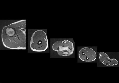 Mri Of Upper Limb Normal Anatomy E Anatomy