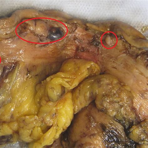 Gross Appearance Of The Small Firm Serosal Nodules Along The Greater Download Scientific