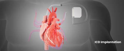 Best Hospital For Icd Implantation Chennai Dr Harikrishnan Cardio