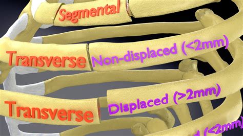 Rib Fracture And Its Types Superhive Formerly Blender Market