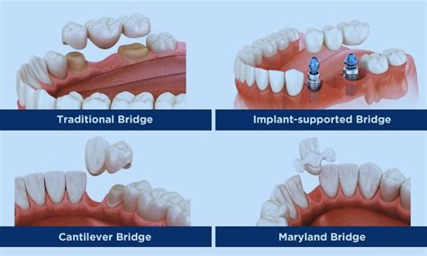3 Unit Dental Bridge