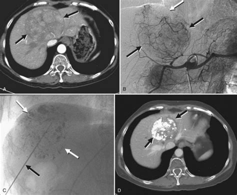 Hepatic Artery Embolization And Chemoembolization Of Liver Tumors Clinical Gate