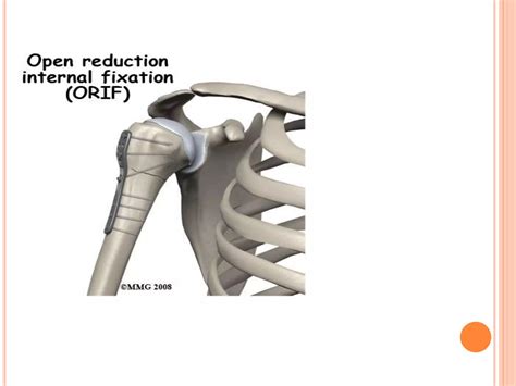 Proximal Humerus Fractures Pptx