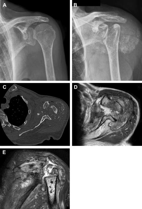 Imaging Of Crystal Disorders Radiologic Clinics