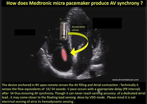 [video] Dr P K Hazra On Linkedin Medtronic Double Chamber Micra Wireless Pacemaker Coming Soon