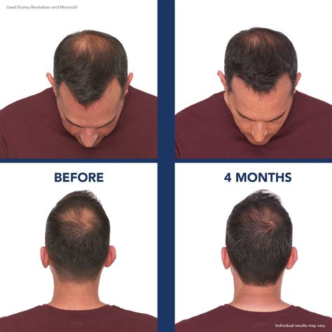 Minoxidil Before And After Men