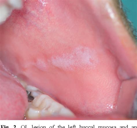 Leukoplakia Buccal Mucosa