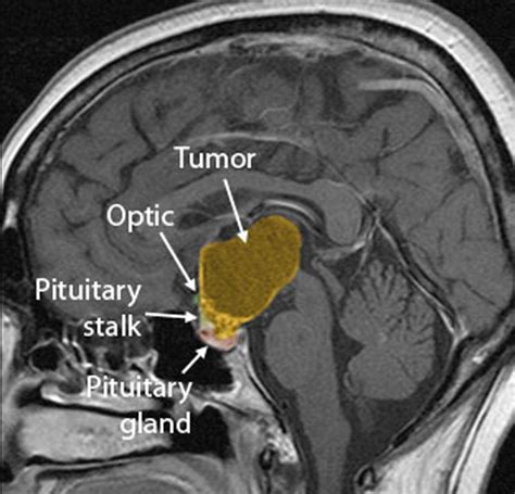 Pituitary Tumor Mri