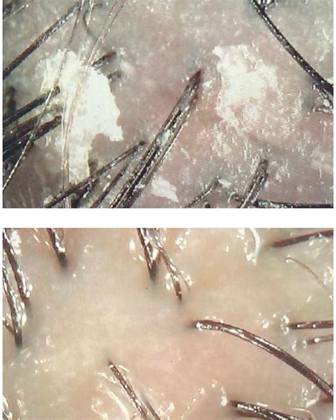 두피의 컨디션 ☑️ 각질 비듬 염증 열감 과다한 피지 국제헤드스파협회대구수성구점교육원