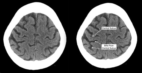 Central Sulcus