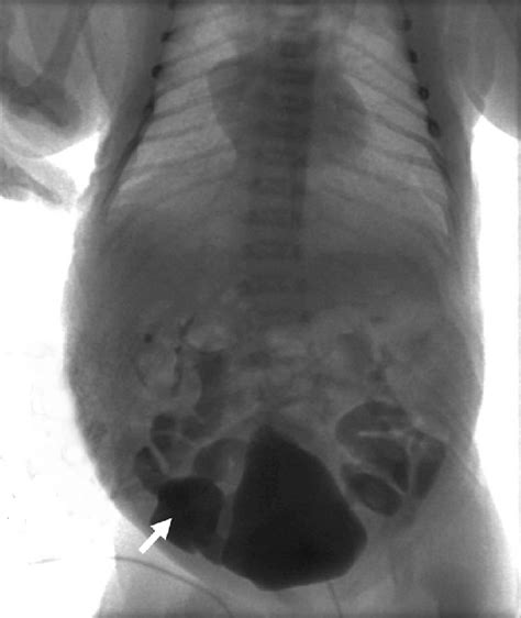 A Voiding Cystourethrogram Showing Bladder Diverticulum And
