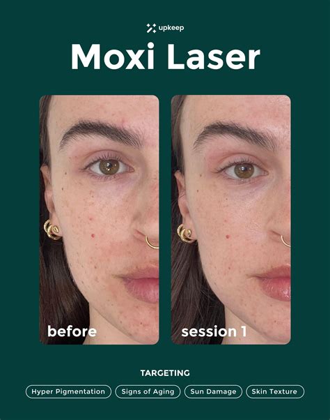Moxi Before After In Skin Facts Skin Clinic Skincare Video