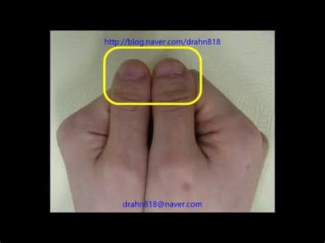 The Cause Hereditary Classification Of Clubbed Thumbsbrachydactyly