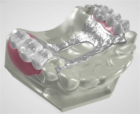 🦷 Prosthodontics Kennedy Class Ii Mod 1 Removable Partial Dentures