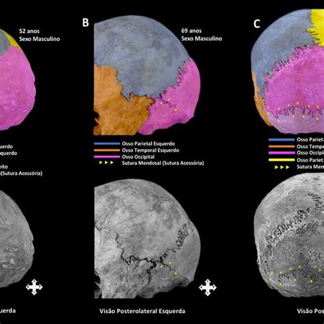 Sutura Mendosal Sutura Acessória A Crânio Do Sexo Masculino 52 Download Scientific Diagram