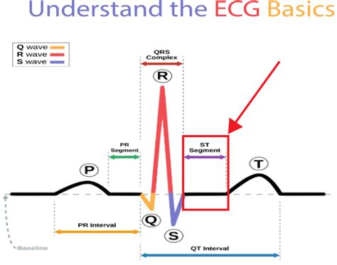 Interpreting ST Elevations On An ECG Electrocardiogram