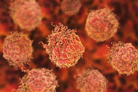 Reduced Psa Prostate Cancer Screening Life Threatening Consequences Research Outreach