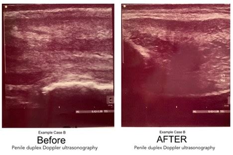 Top 4 Peyronies Disease Causes