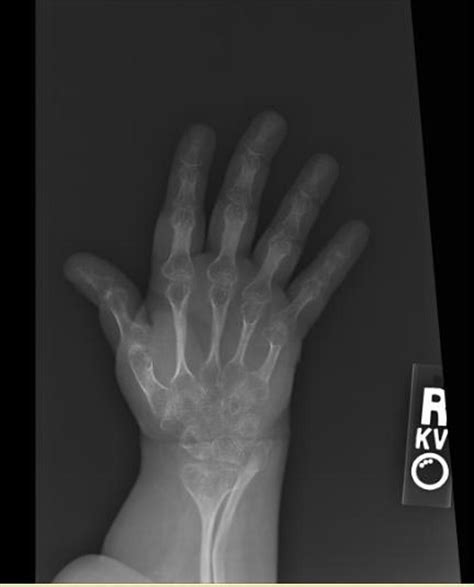 Osteoporotic Bone X Ray