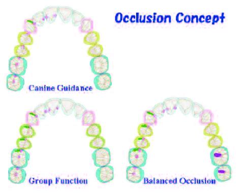 The Ultimate Goal Of Any Anterior Guidance Concept Should Be To